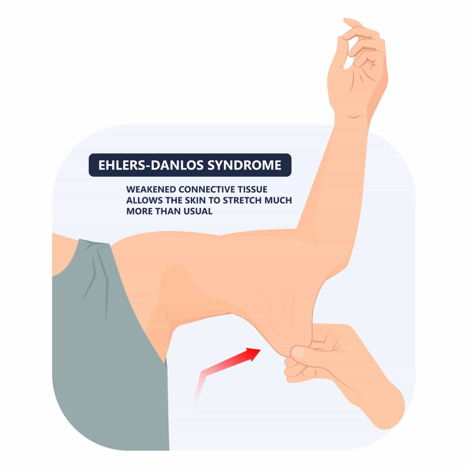 Understanding Ehlers-Danlos syndromes