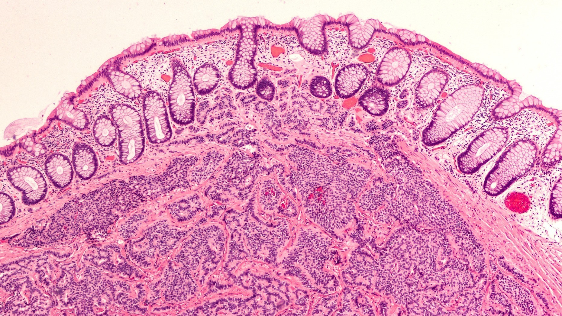 Colon cancer: Do not ignore these symptoms