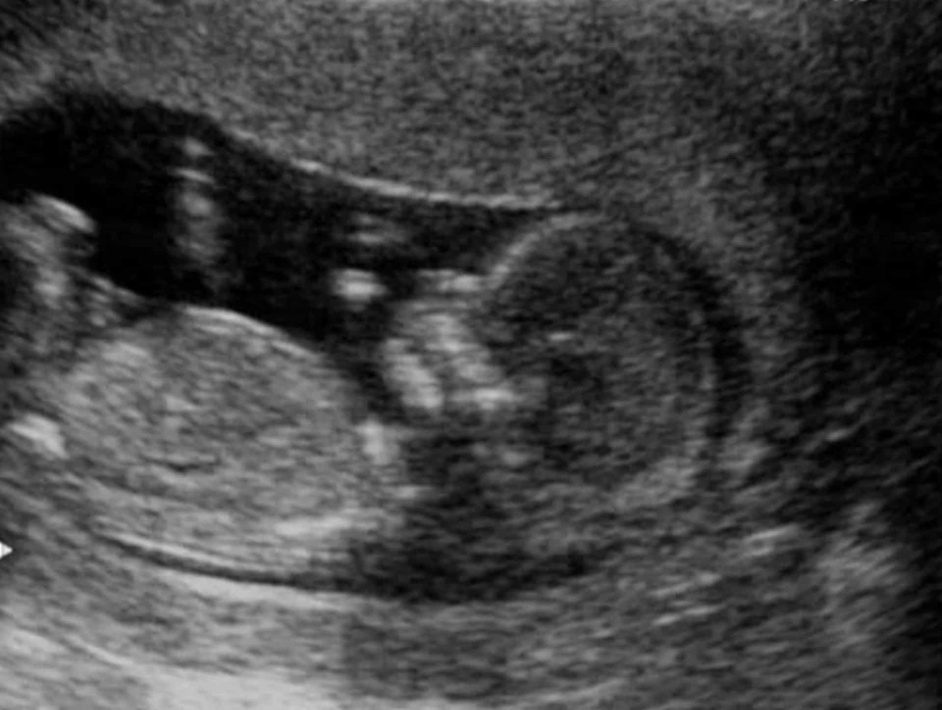 The dangers of a premature birth