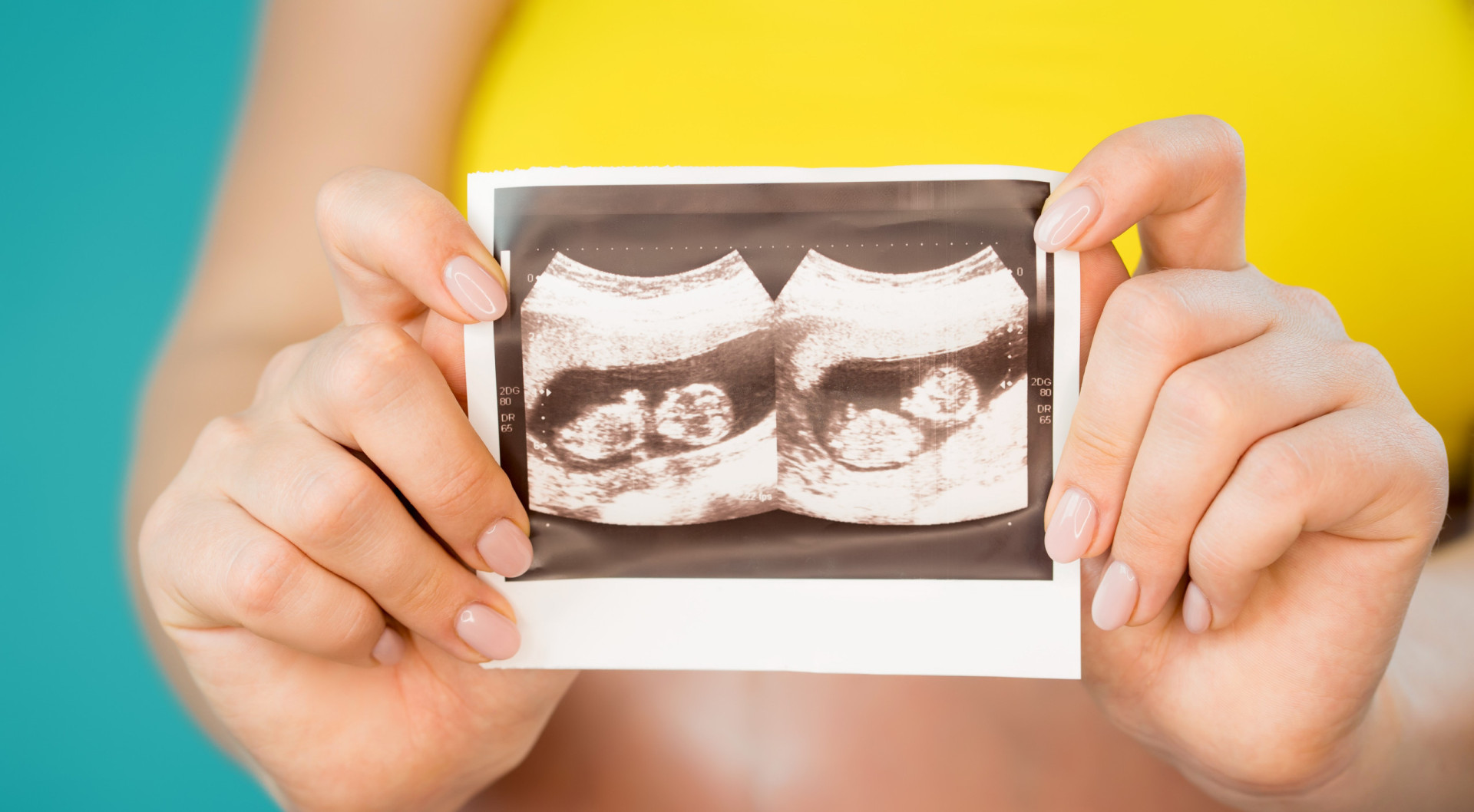 Woman with two uteruses gives birth to twins on different days