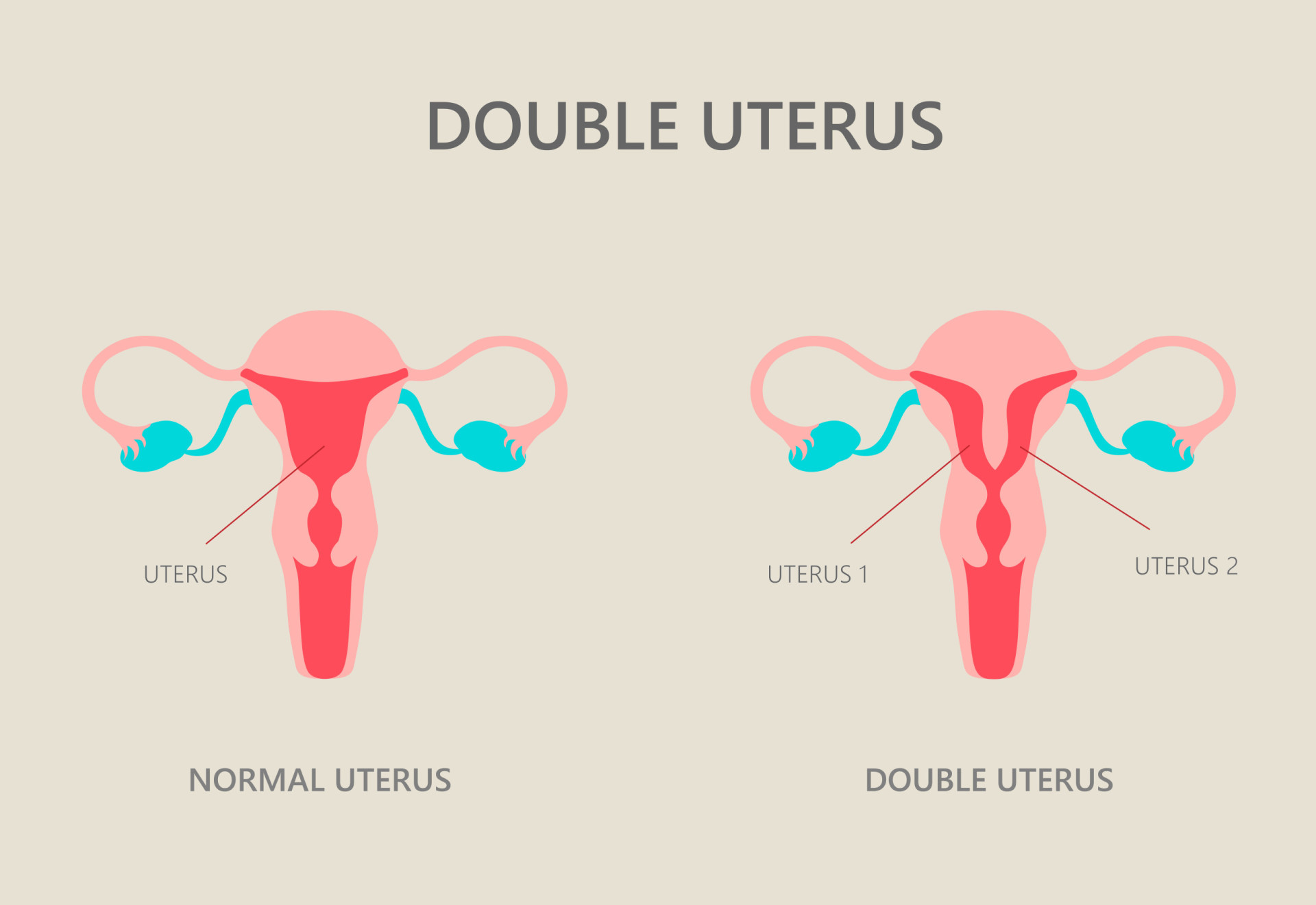 Woman With Two Uteruses Gives Birth To Twins On Different Days