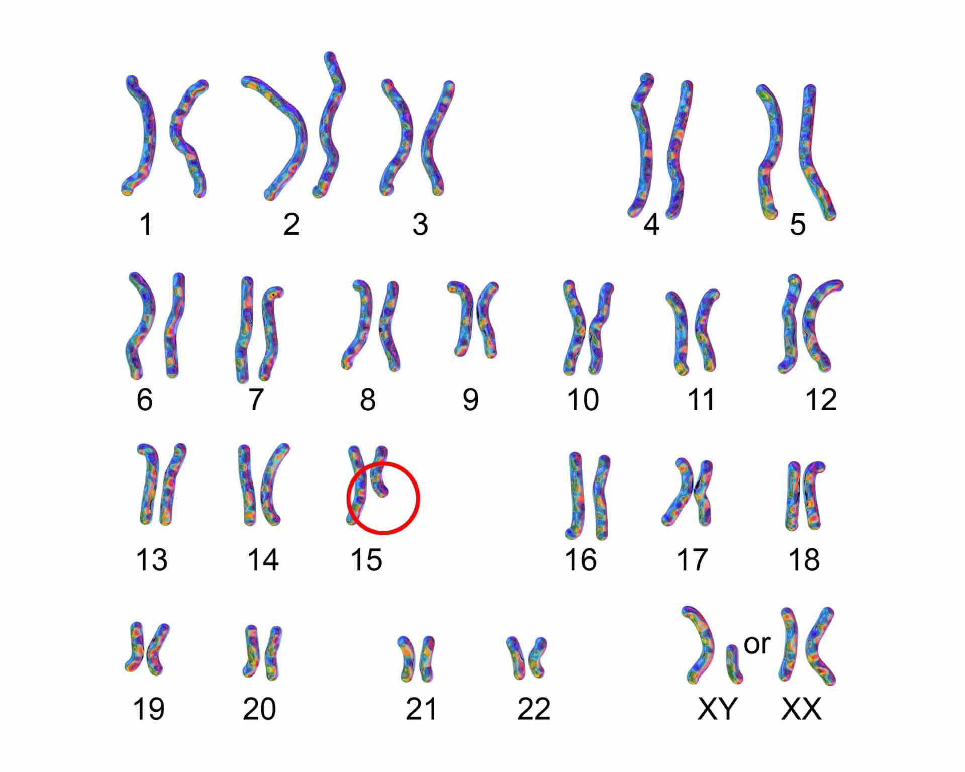 Prader-Willi syndrome: the rare condition affecting infants and children
