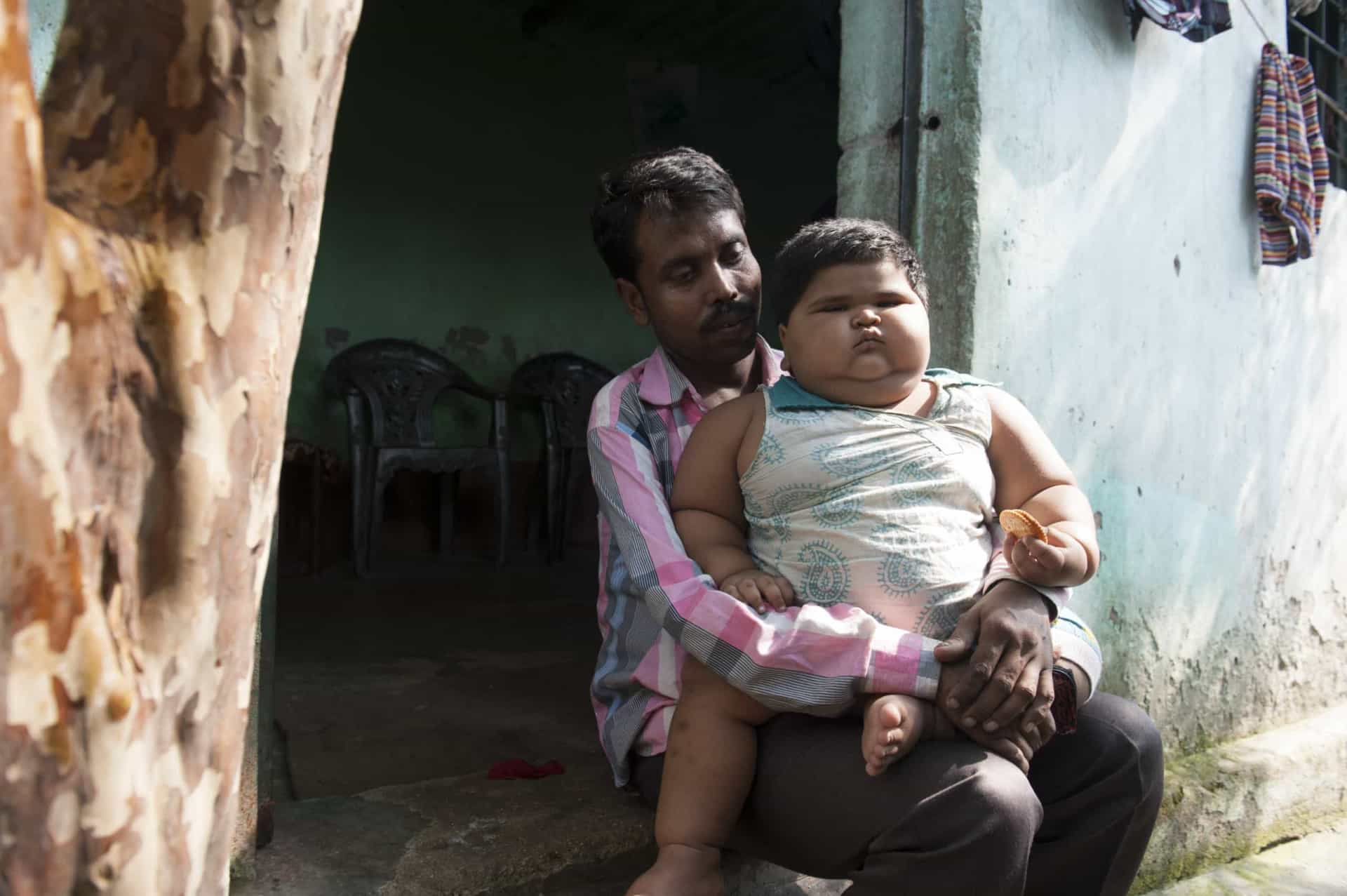 Prader-Willi syndrome: the rare condition affecting infants and children