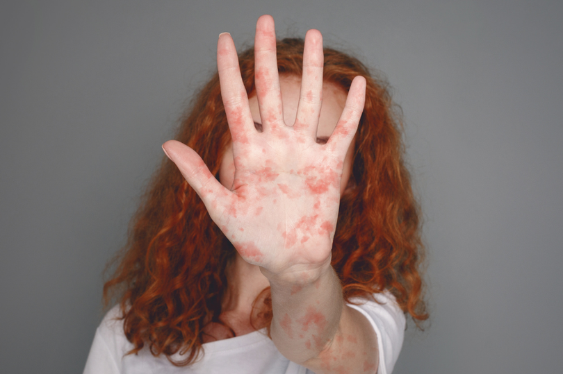 Measles, mumps and rubella warning issued across Kirklees