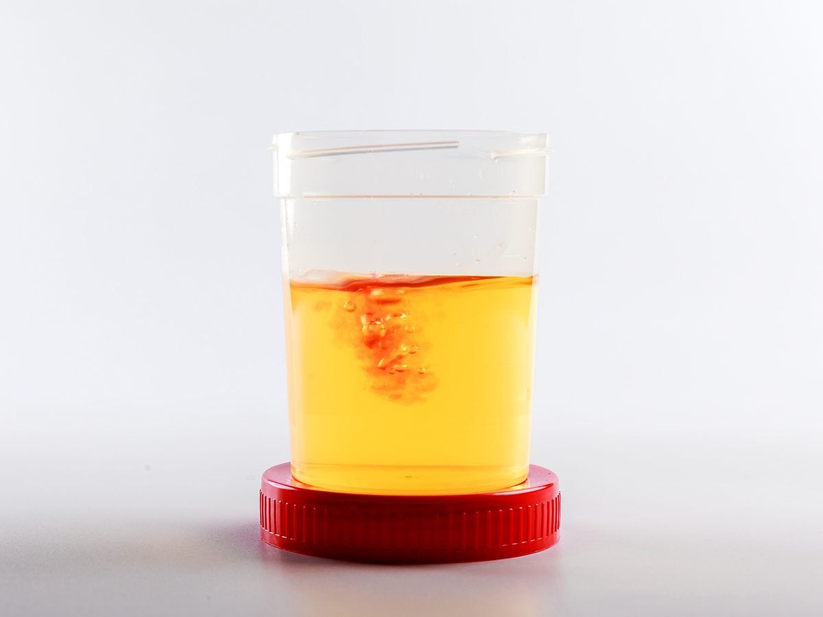 6 causes of blood in urine