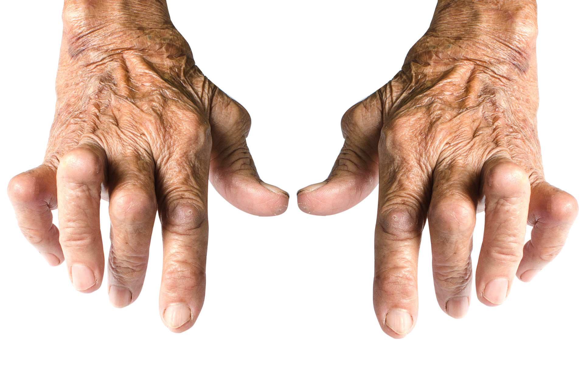 Arthritis and arthrosis: understanding the differences and treatments