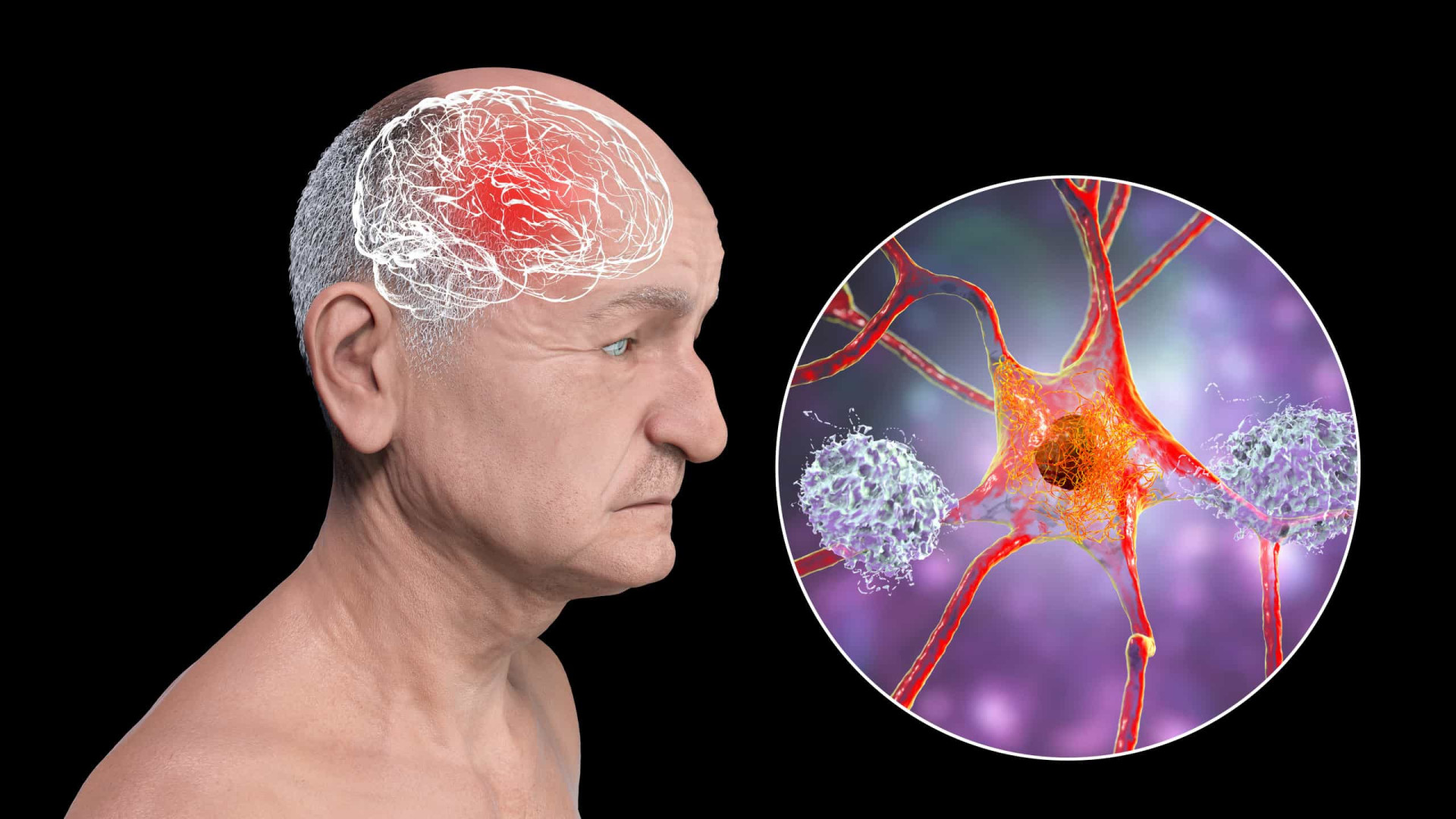 Everything you need to know about Alzheimer's disease