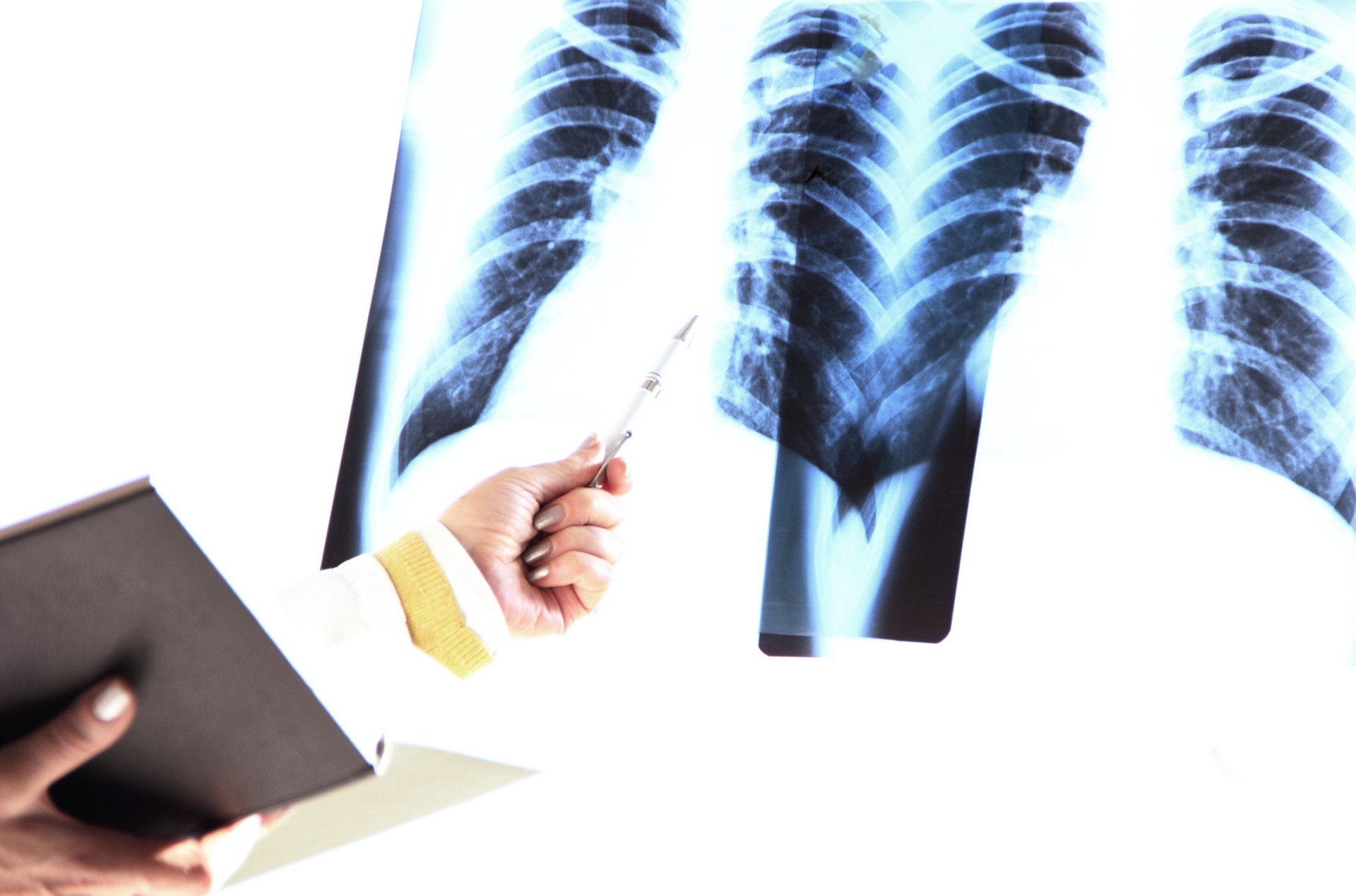 Osteoporosis The Silent Disease