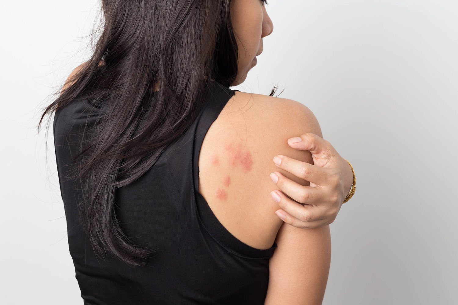 Pictures and expert advice to help you identify 23 common skin rashes