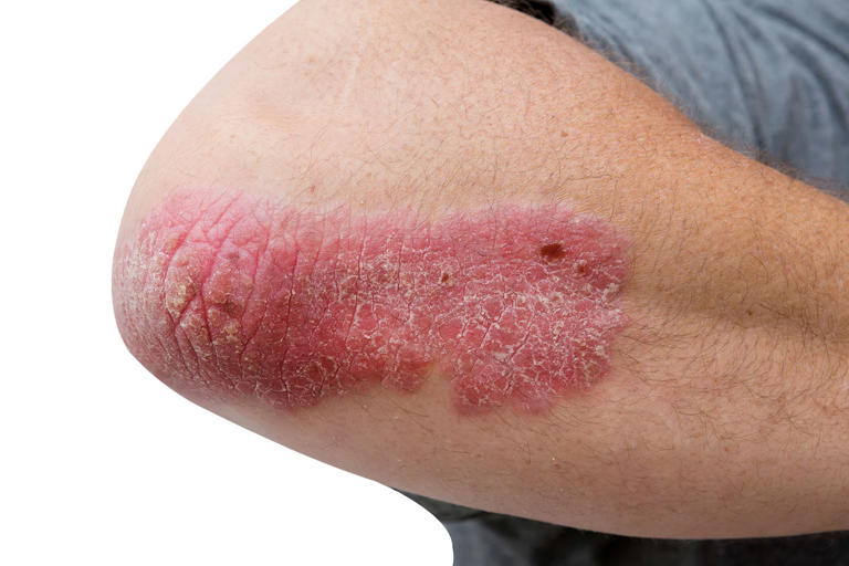 Pictures and expert advice to help you identify 23 common skin rashes