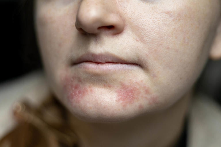 Pictures and expert advice to help you identify 23 common skin rashes