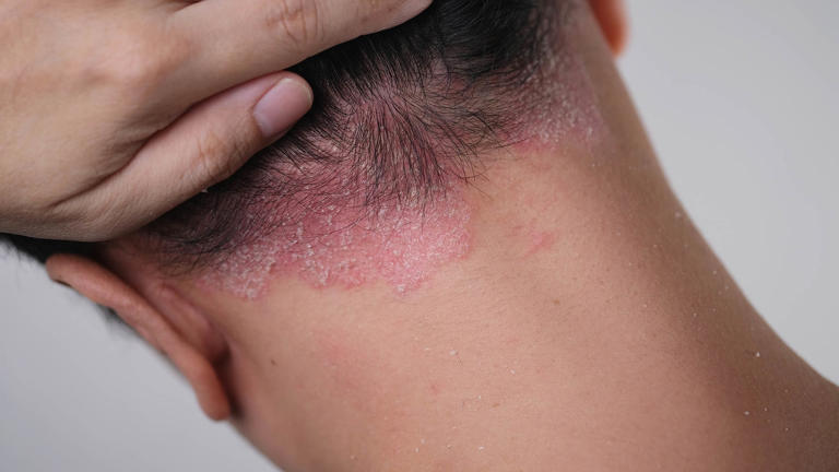 Pictures and expert advice to help you identify 23 common skin rashes