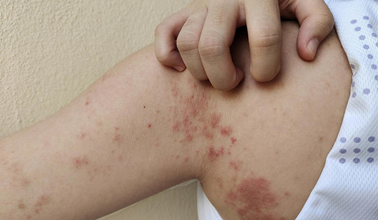 Pictures and expert advice to help you identify 23 common skin rashes