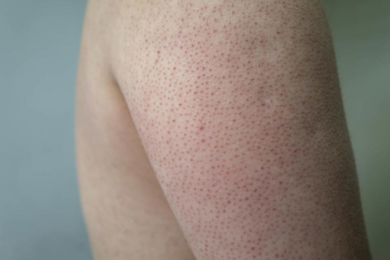 Pictures and expert advice to help you identify 23 common skin rashes