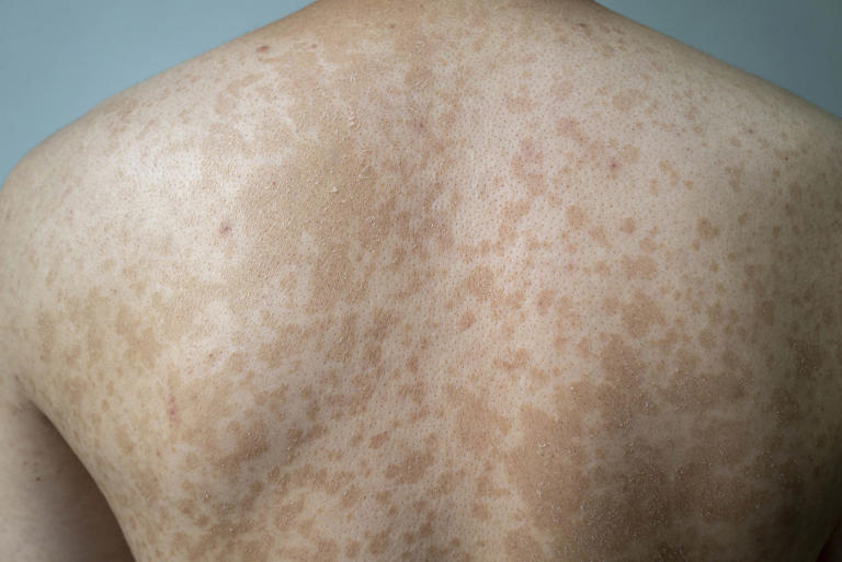 Pictures and expert advice to help you identify 23 common skin rashes