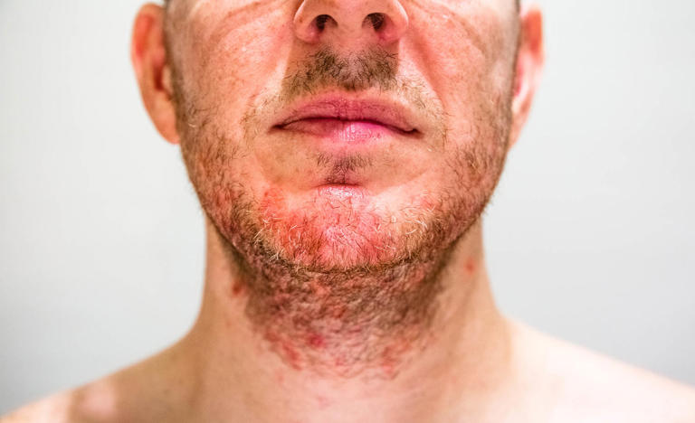 Pictures and expert advice to help you identify 23 common skin rashes