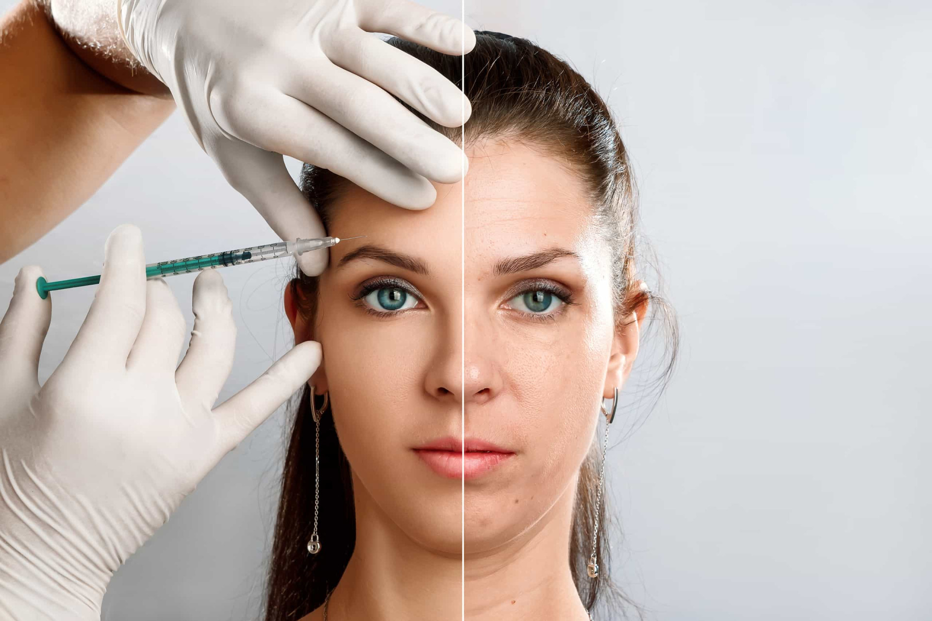 What you should know before getting Botox