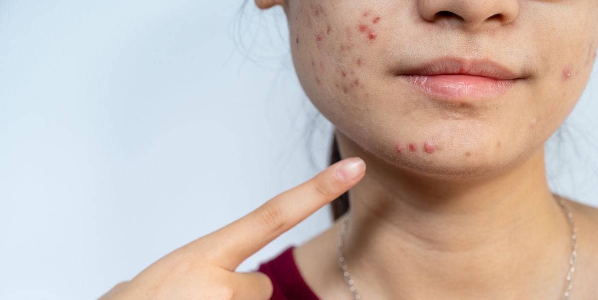 5 ways to deal with a spotty chin according to a dermatologist