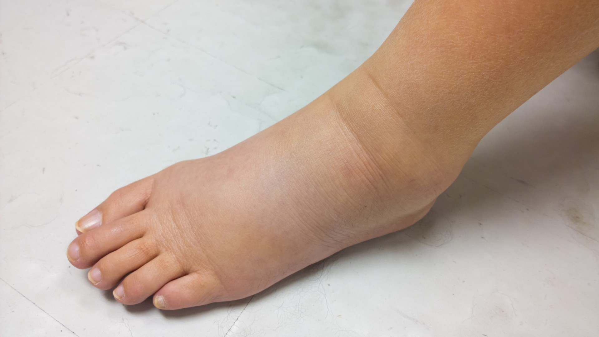 Everything you need to know about edema