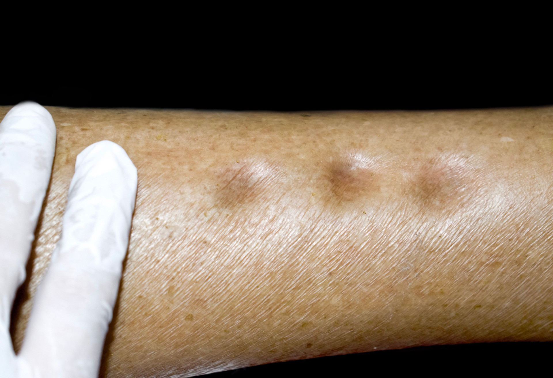 Everything you need to know about edema