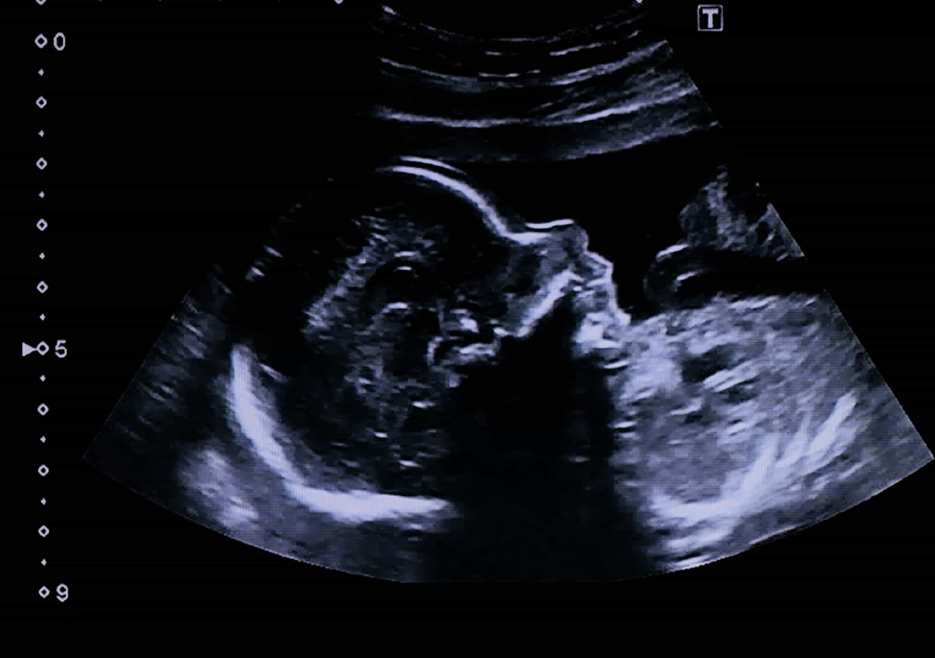 What is mirror syndrome?