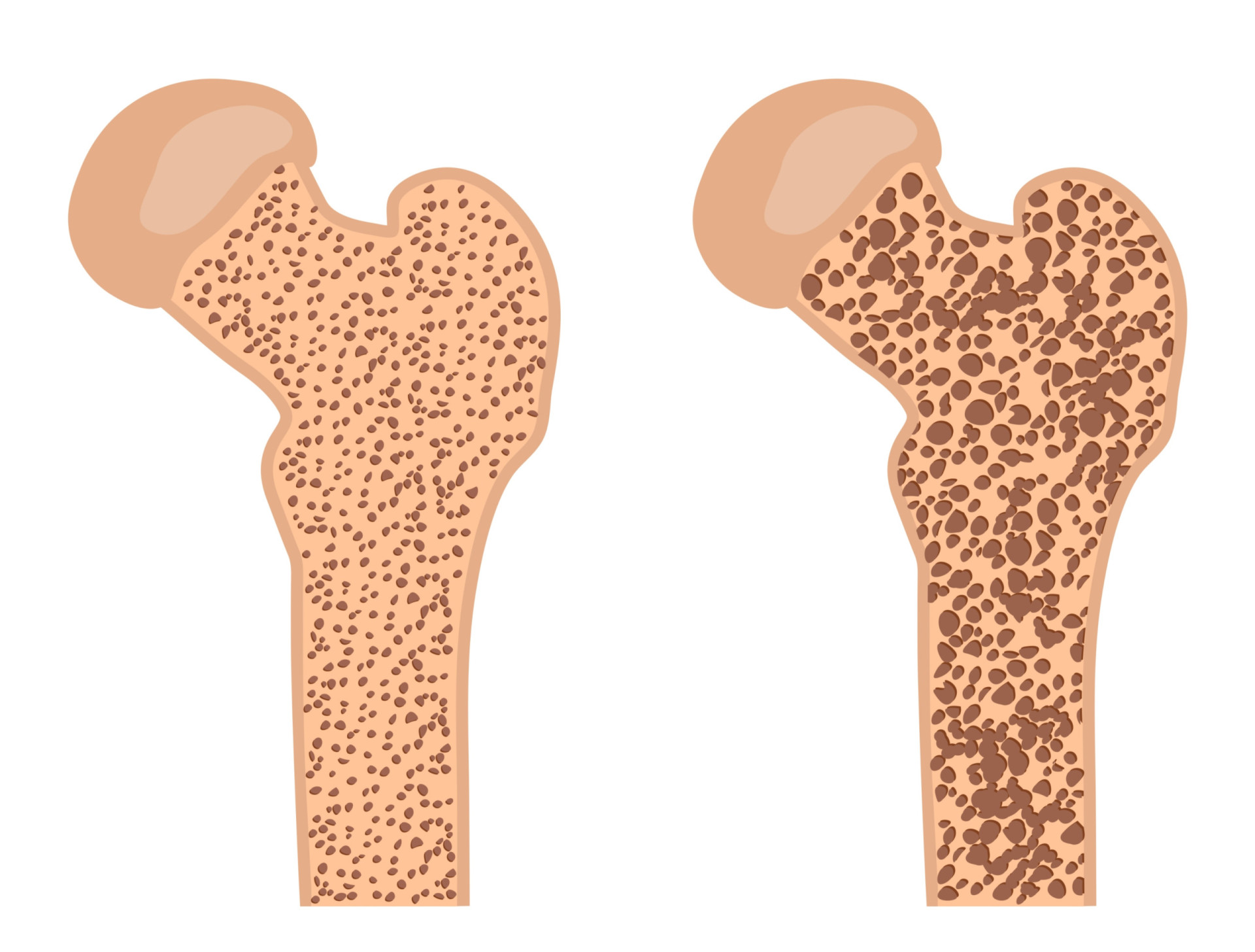 Quelles sont les maladies qui attaquent les os du corps humain