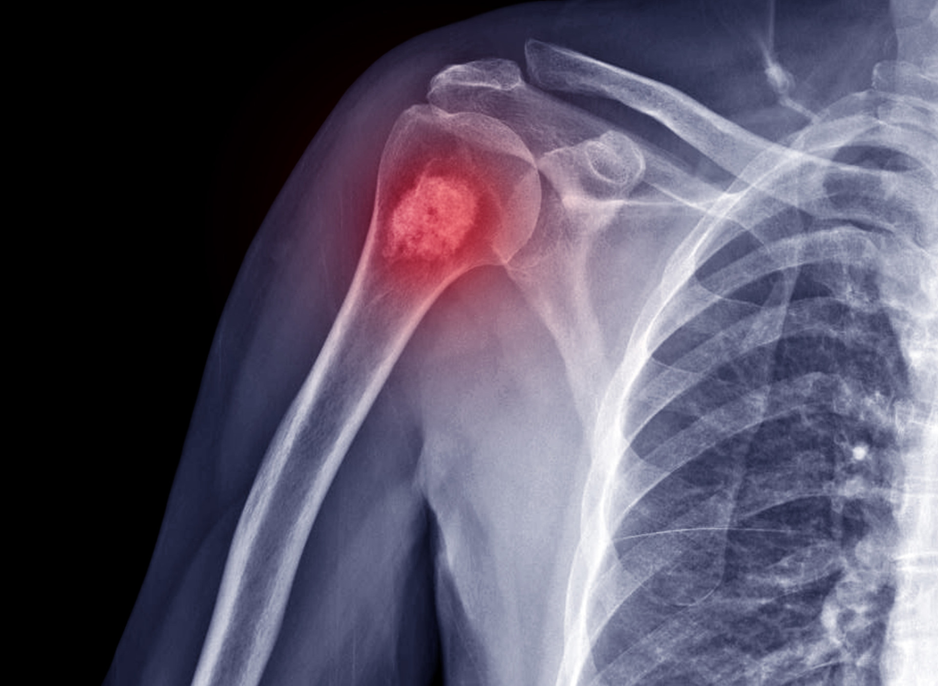 Quelles sont les maladies qui attaquent les os du corps humain