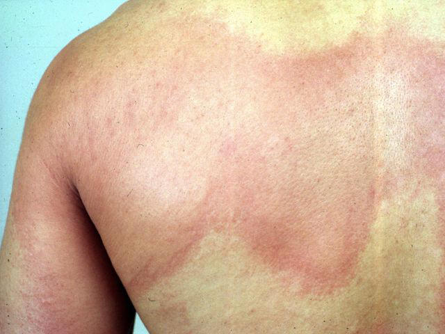 Identify a Lyme Disease Rash With This Photo Guide