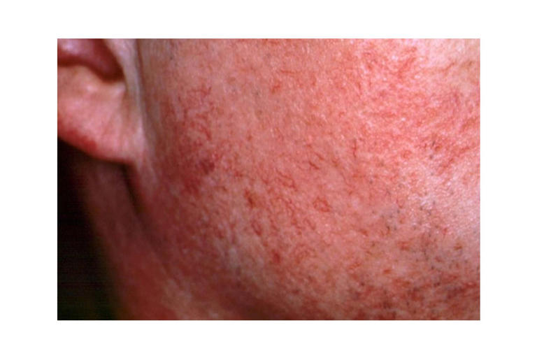 What’s That Rash? How to ID 14 of the Most Common Skin Irritations