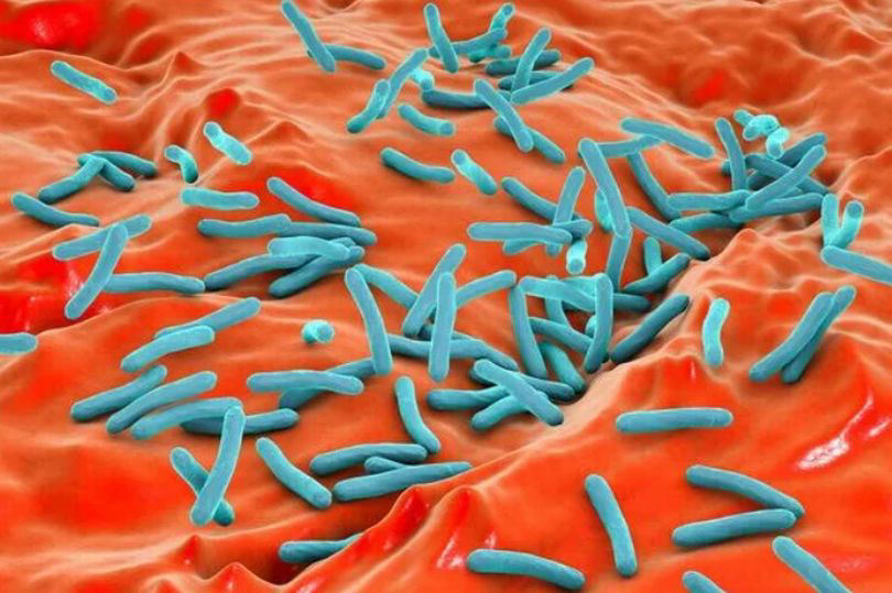 Victorian-era disease becomes 'world's top killer' as urgent plea issued Victorian-era disease becomes 'world's top killer' as urgent plea issued