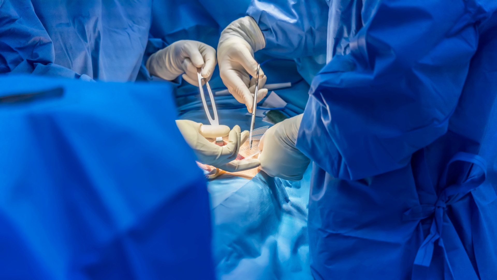 Major types of abdominal surgeries, and their recovery time