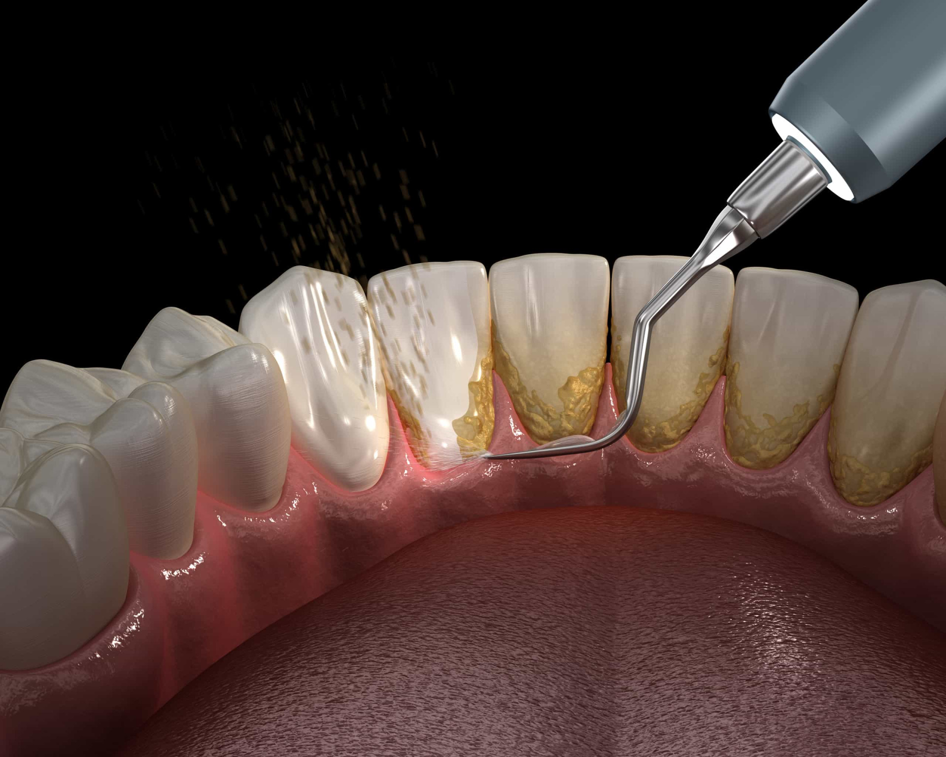 Understanding gingivitis and how to avoid it