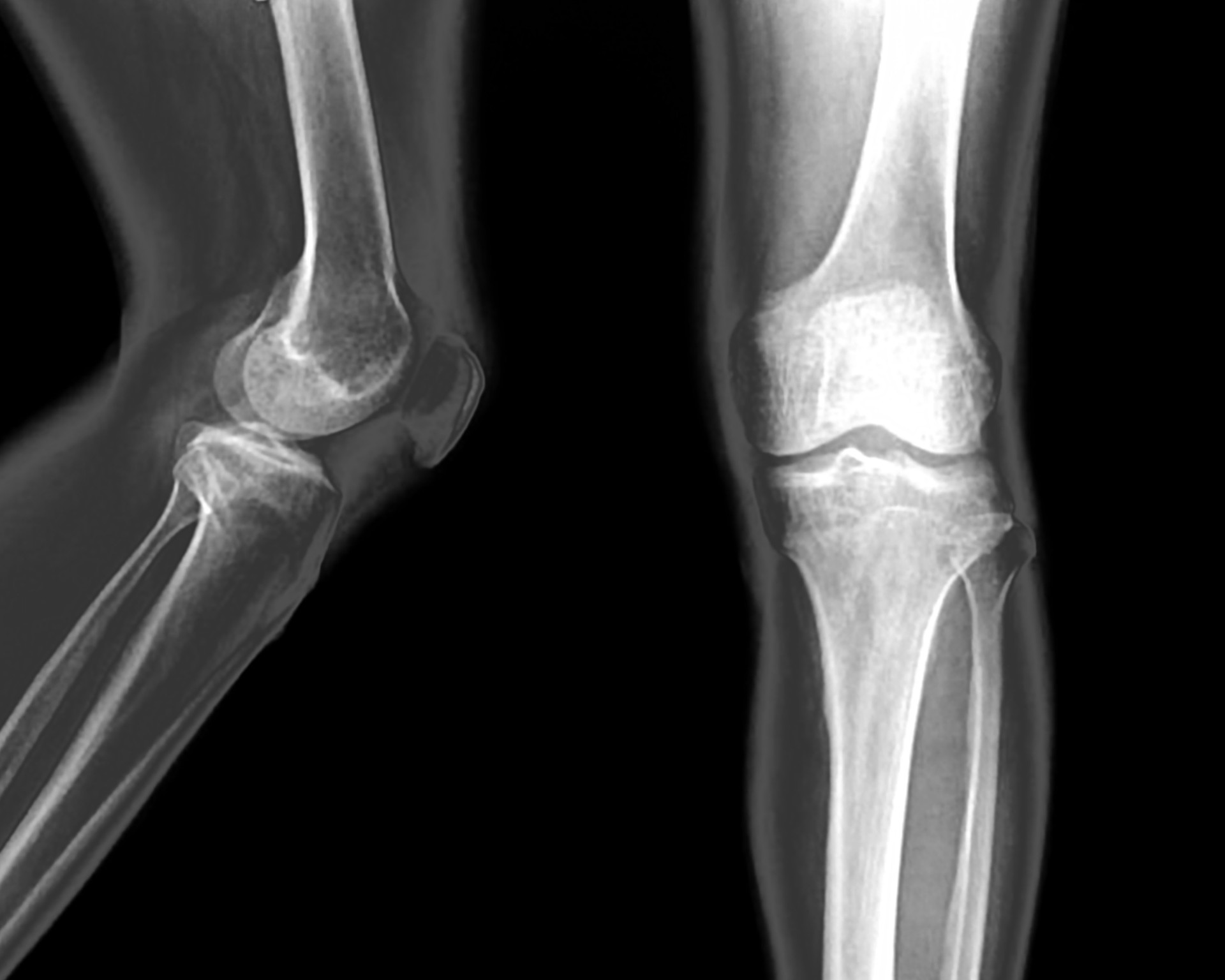 Arthritis and arthrosis: understanding the differences and treatments