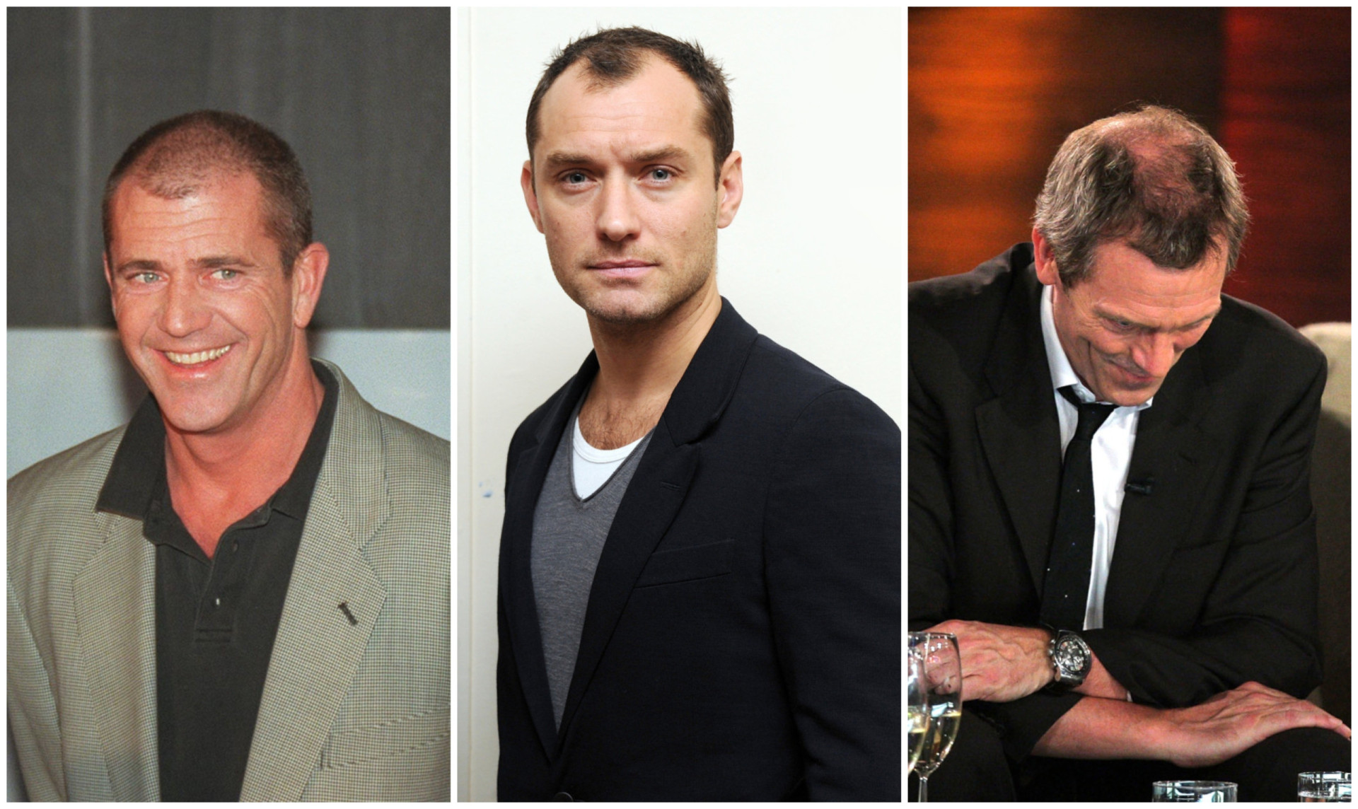 Ces hommes célèbres ont subi une greffe de cheveux