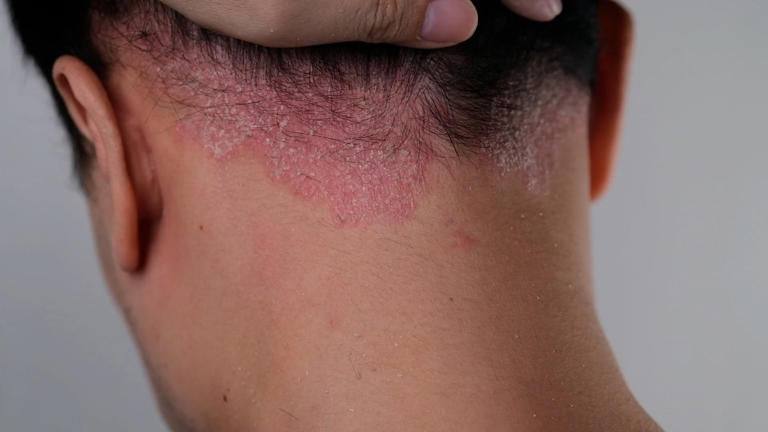 Psoriasis Triggers: How Your Environment Can Cause Flare-Ups