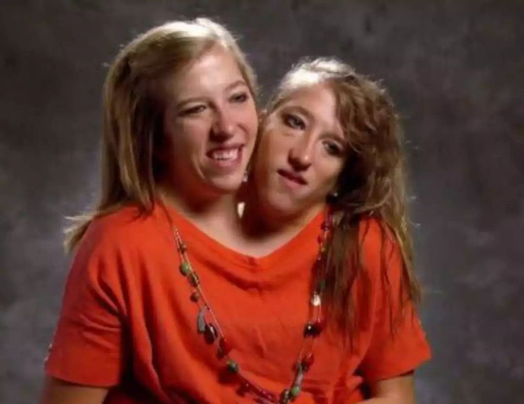 Conjoined twins Abby and Brittany Hensel respond to viral baby photos