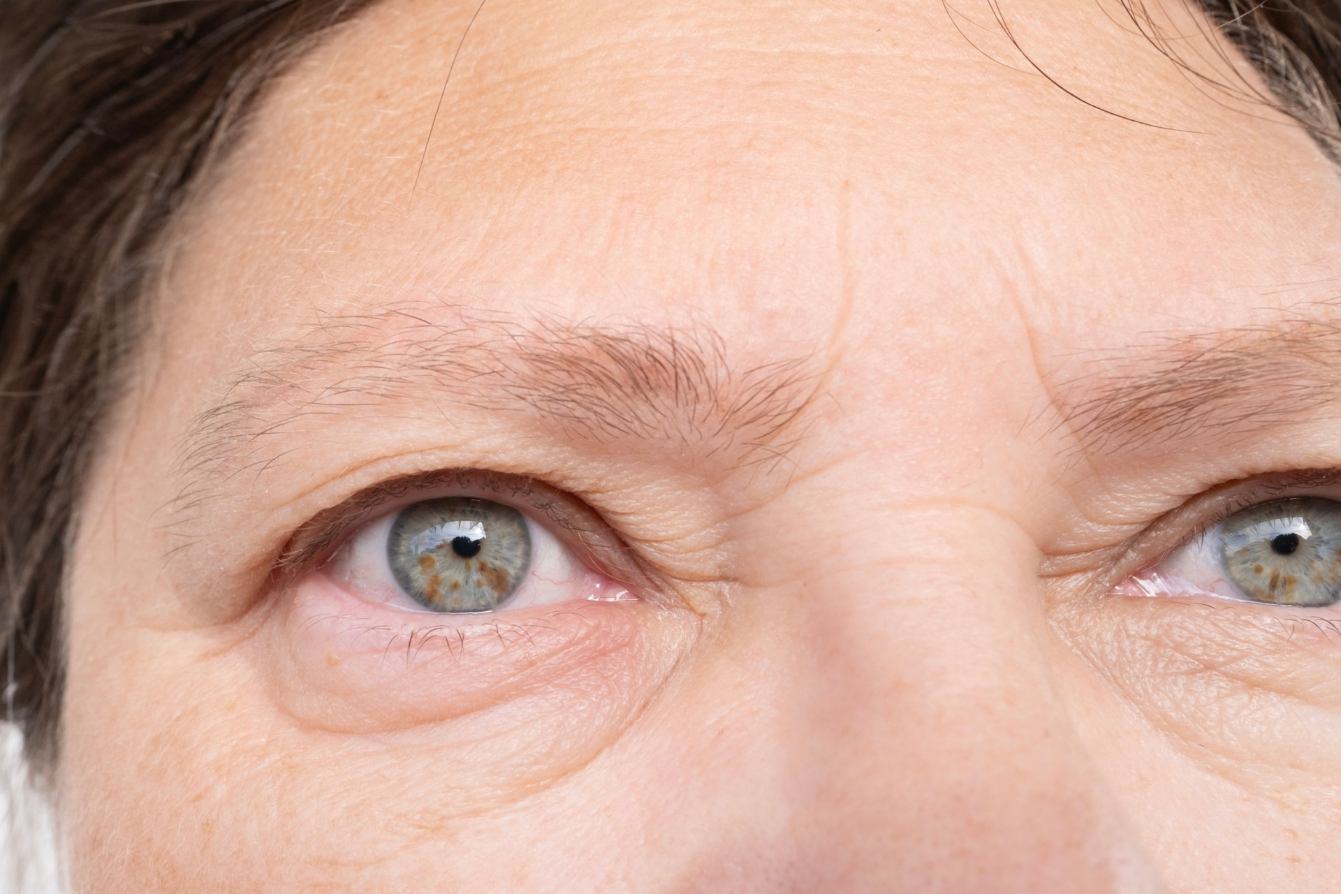Puffy eyes: possible causes, and how to get rid of them