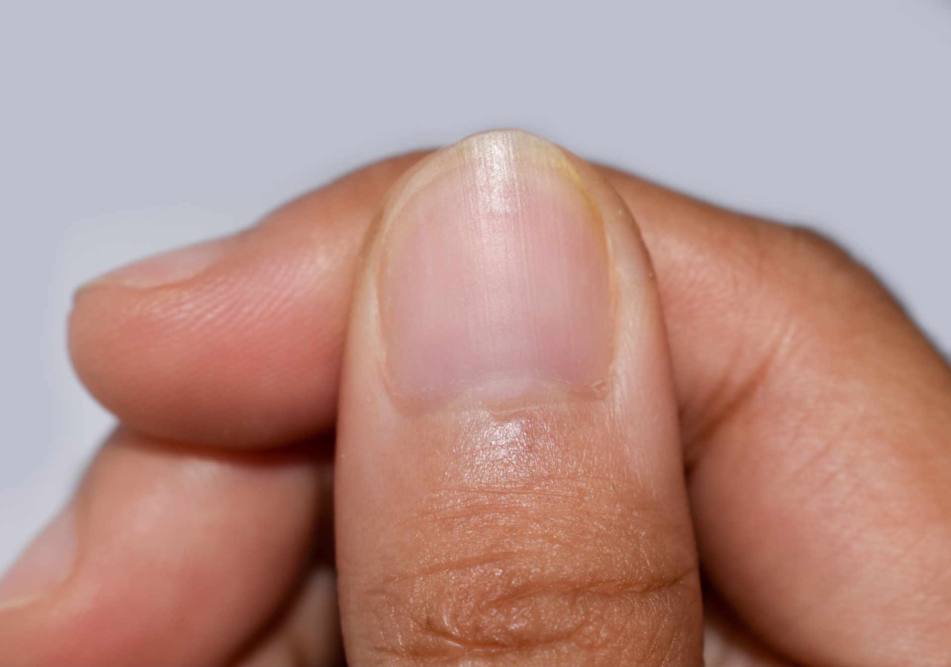 Co vaše nehty říkají o vašem zdraví?