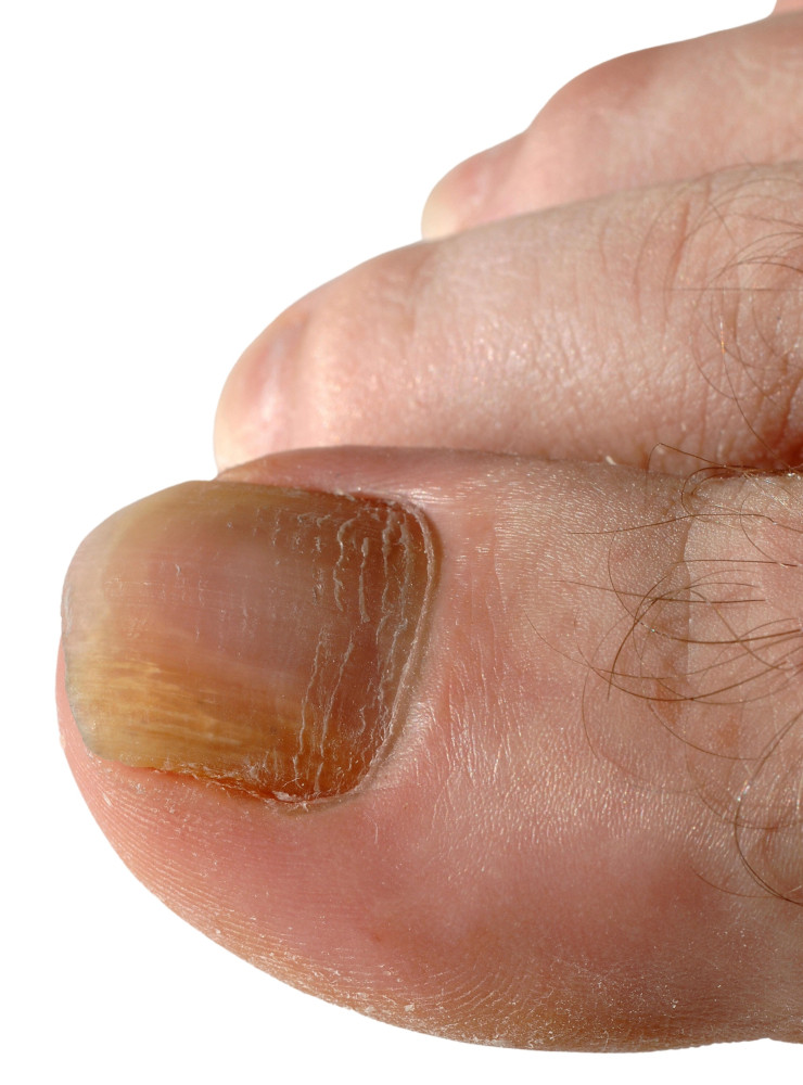 Co paznokcie mówią o Twoim zdrowiu