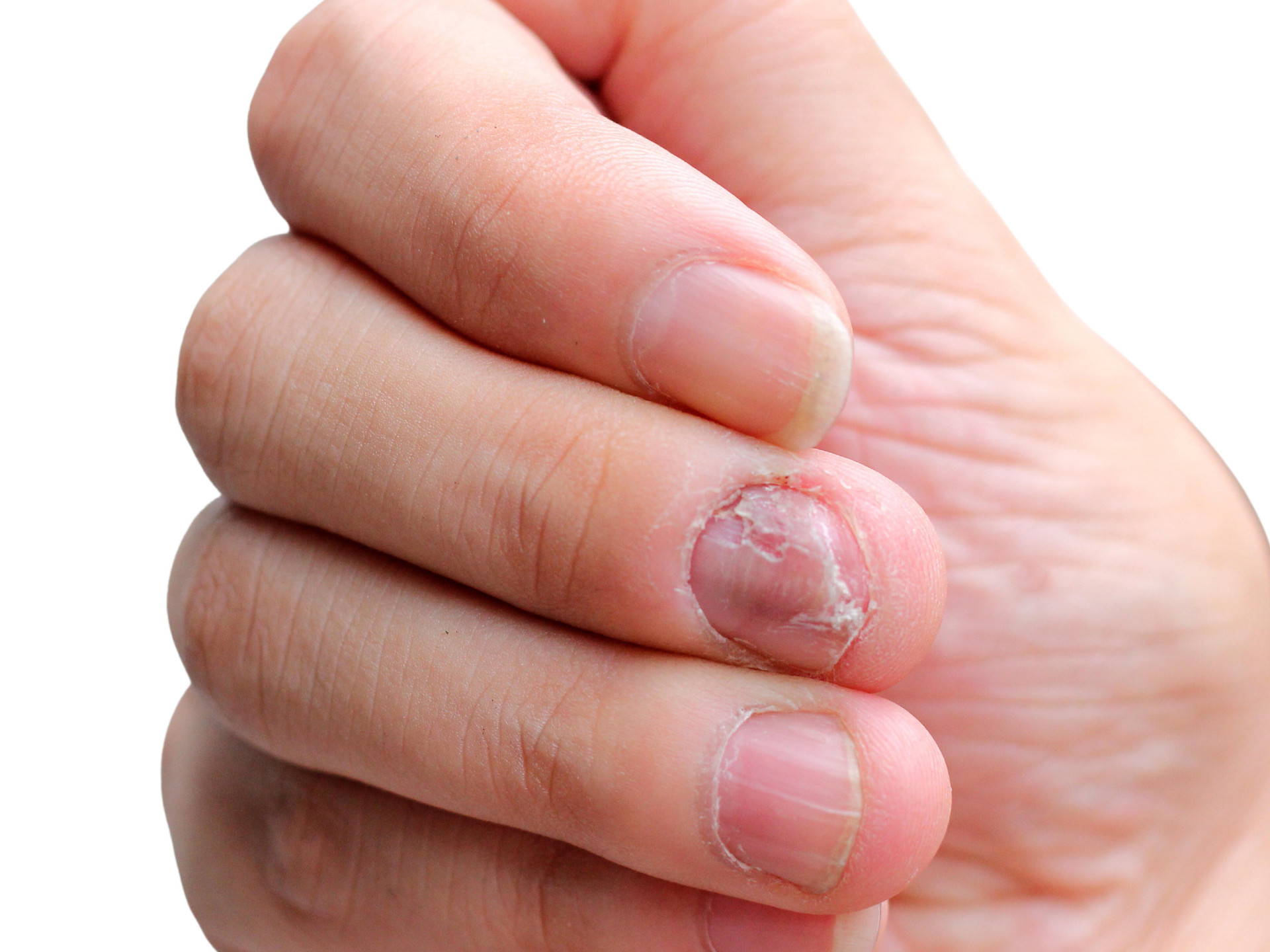 Co paznokcie mówią o Twoim zdrowiu