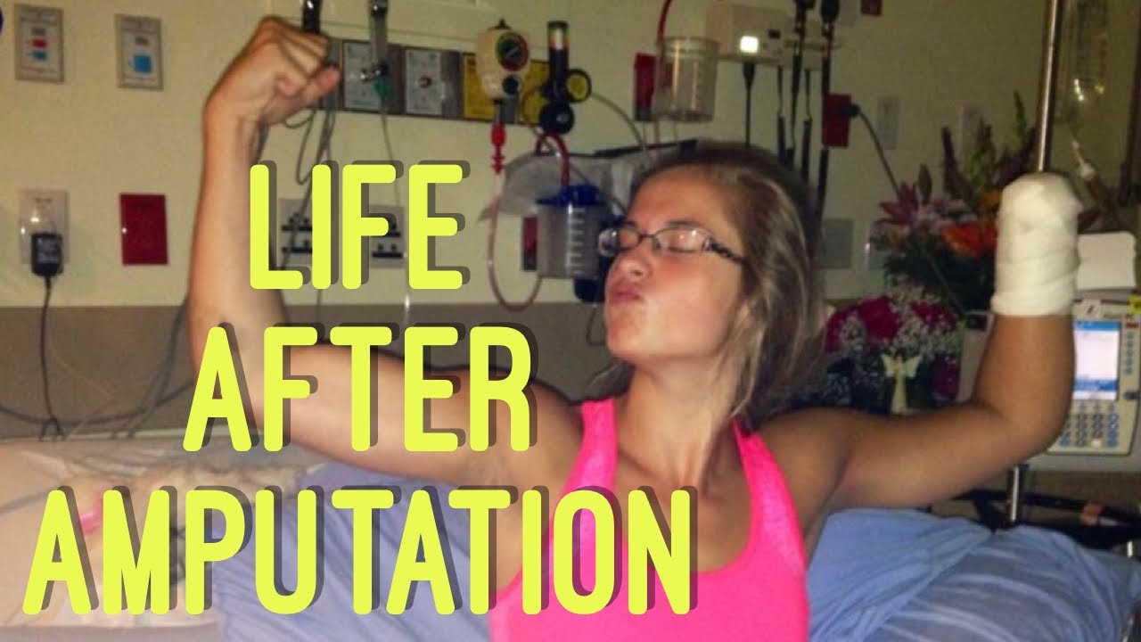 HOW I SURVIVED the HARDEST PART of Amputation Recovery!