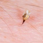 Identifying Bug Bites: How to Figure Out What Bit You