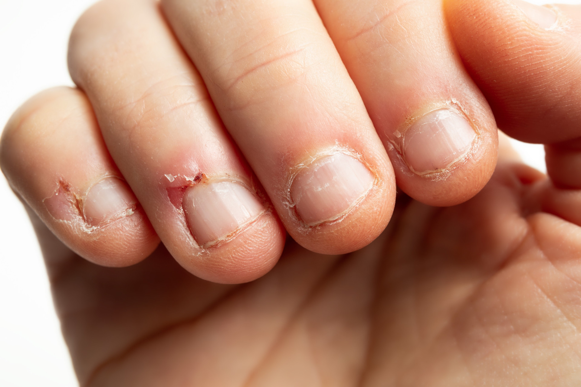 Marre de vous ronger les ongles ? Voici quelques astuces pour vous aider à arrêter