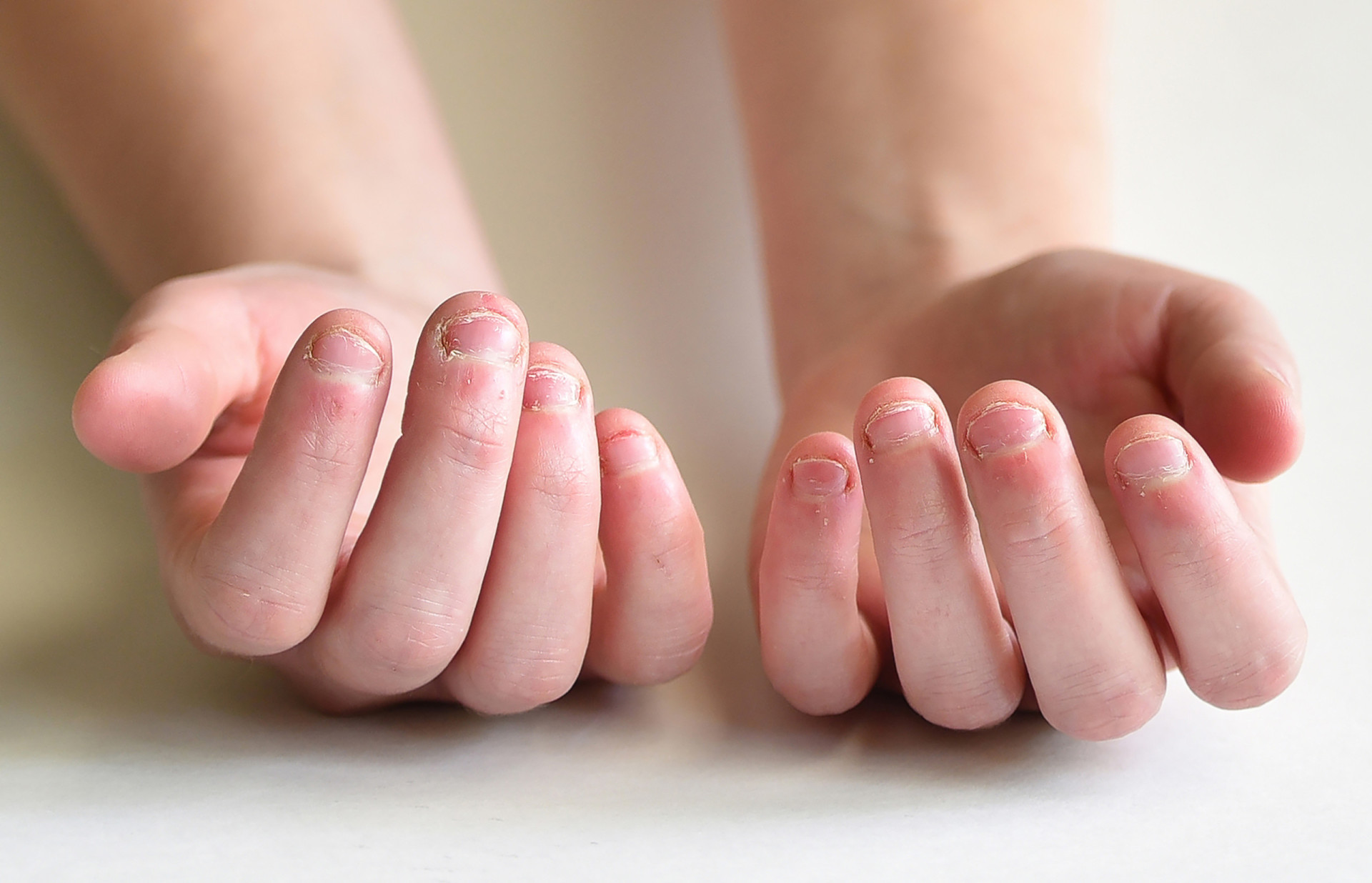 Alt du trenger å vite om neglebiting og hvordan du slutter med uvanen