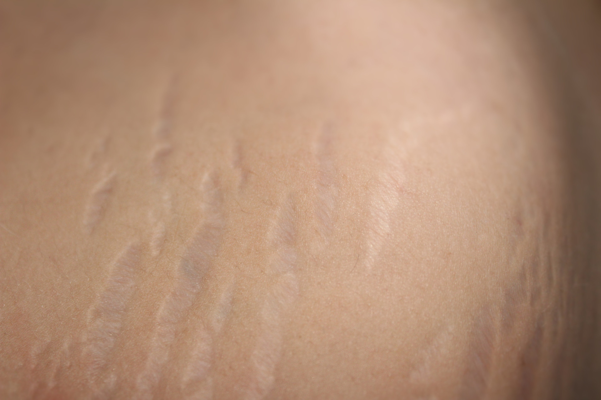 Le "visage Ozempic" et les effets d'une perte de poids rapide sur le corps