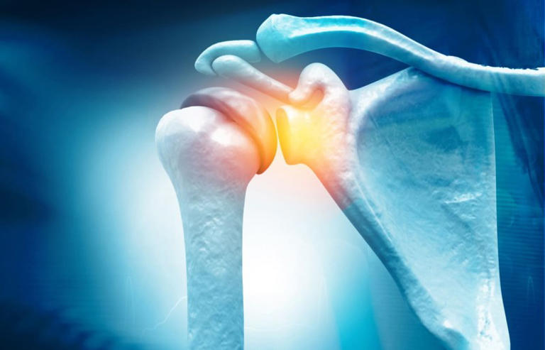Meniscus Tears and Other Age and Exercise-Related Injuries