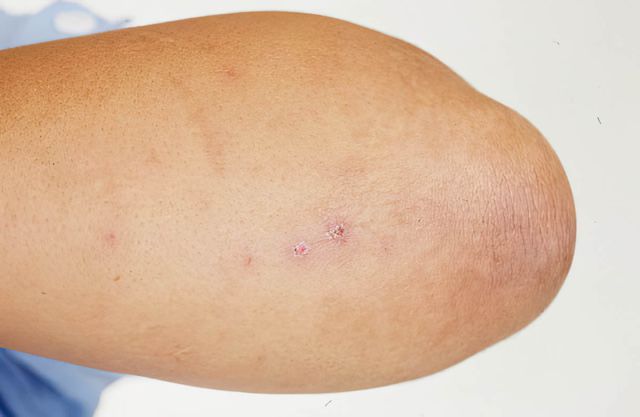 A Visual Guide to How Gonorrhea Looks