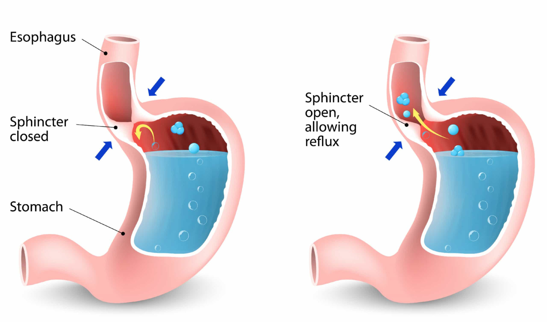 Azia: Como domar a terrível sensação de queimação