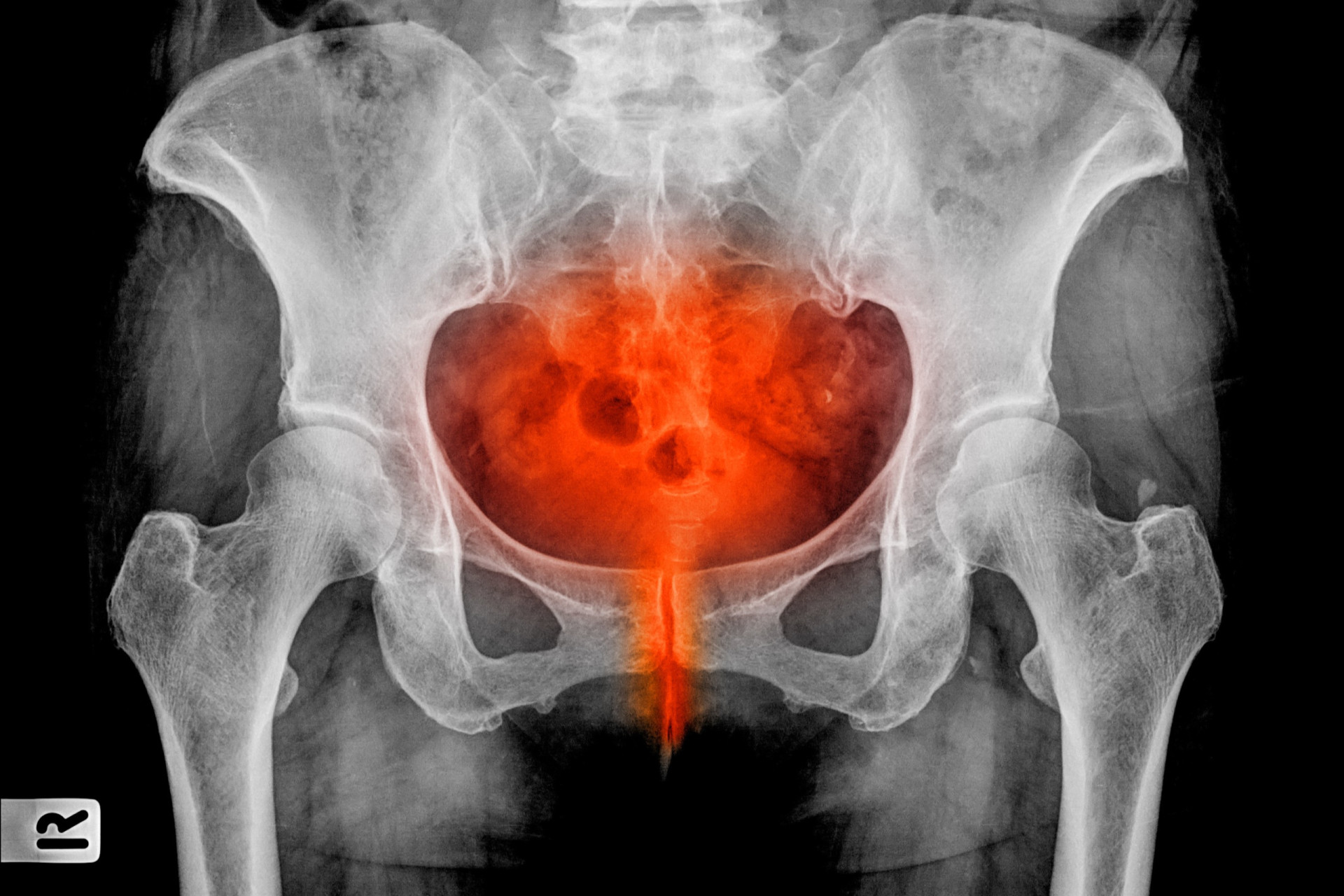 Infections urinaires : les aliments à privilégier et à éviter