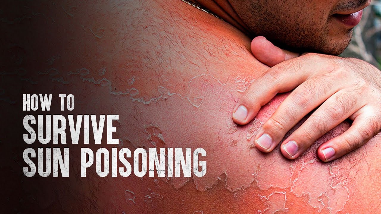 The Truth About Sun Poisoning and How to Treat It